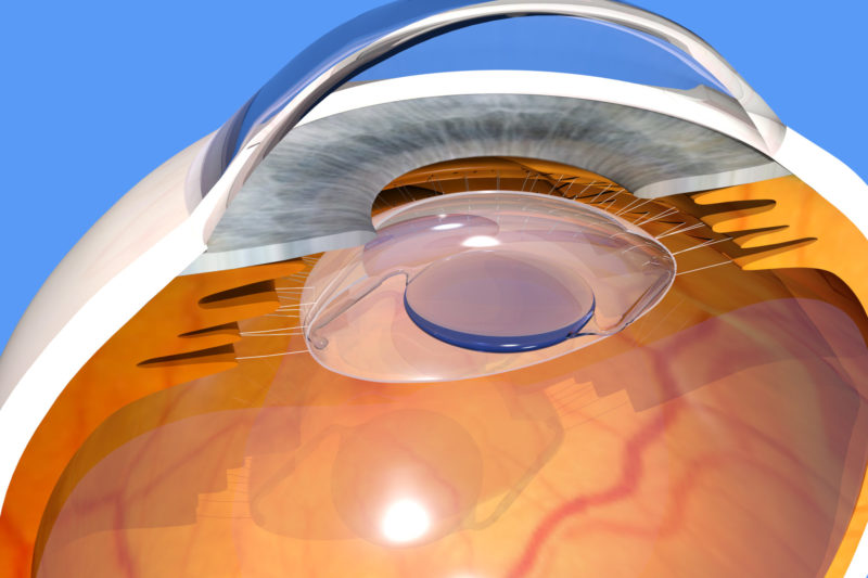 Types Of Intraocular Lenses Multifocal Lenses Hereford Eye Surgery